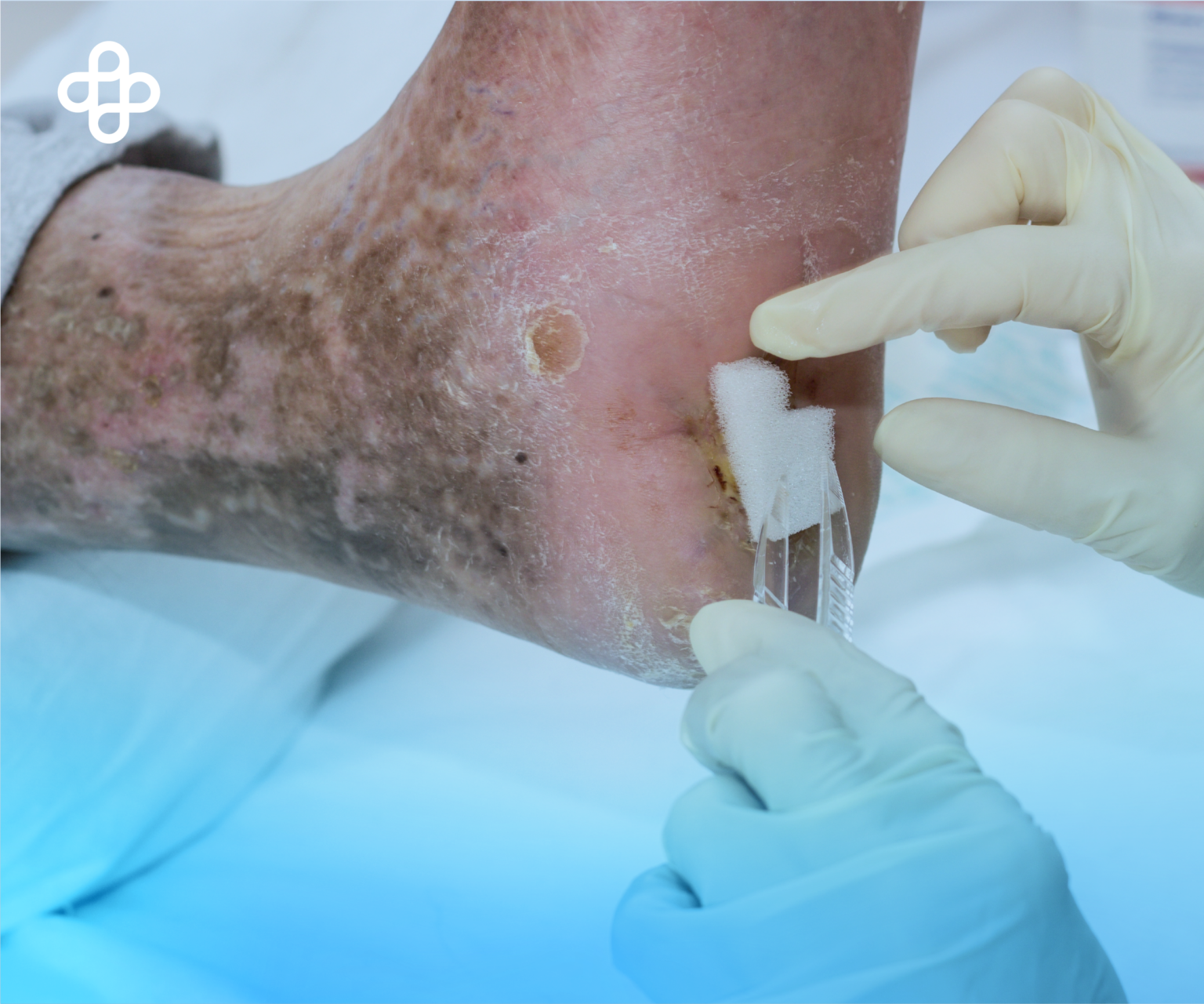 ¿Qué es el pie diabético? - Centro Médico Eternal