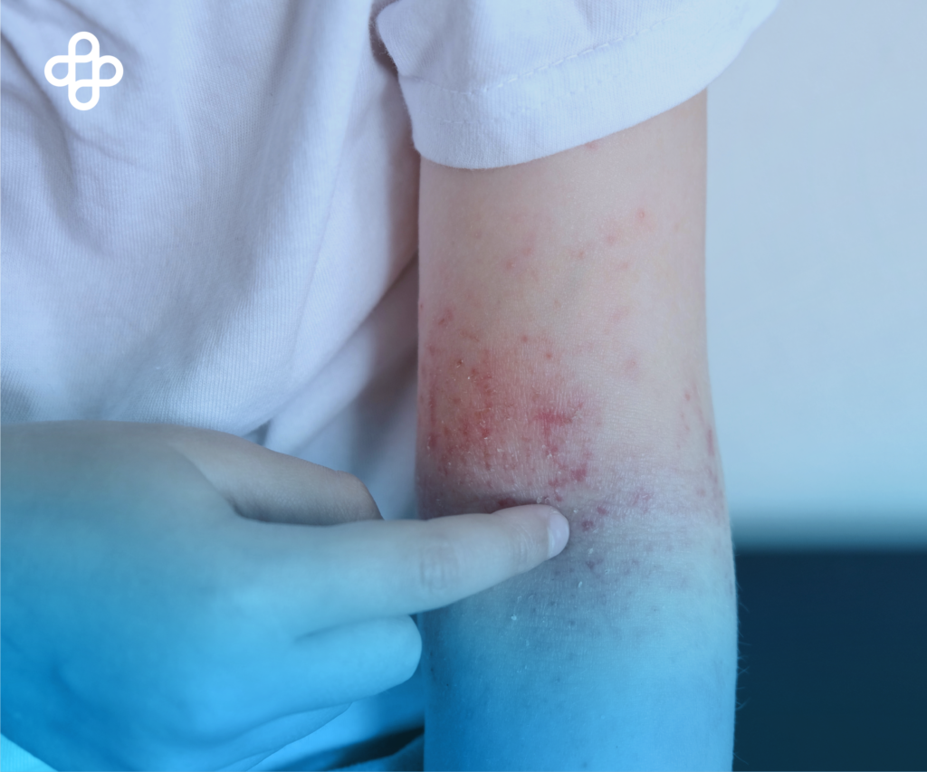 Síntomas de la Psoriasis - Centro Médico Eternal